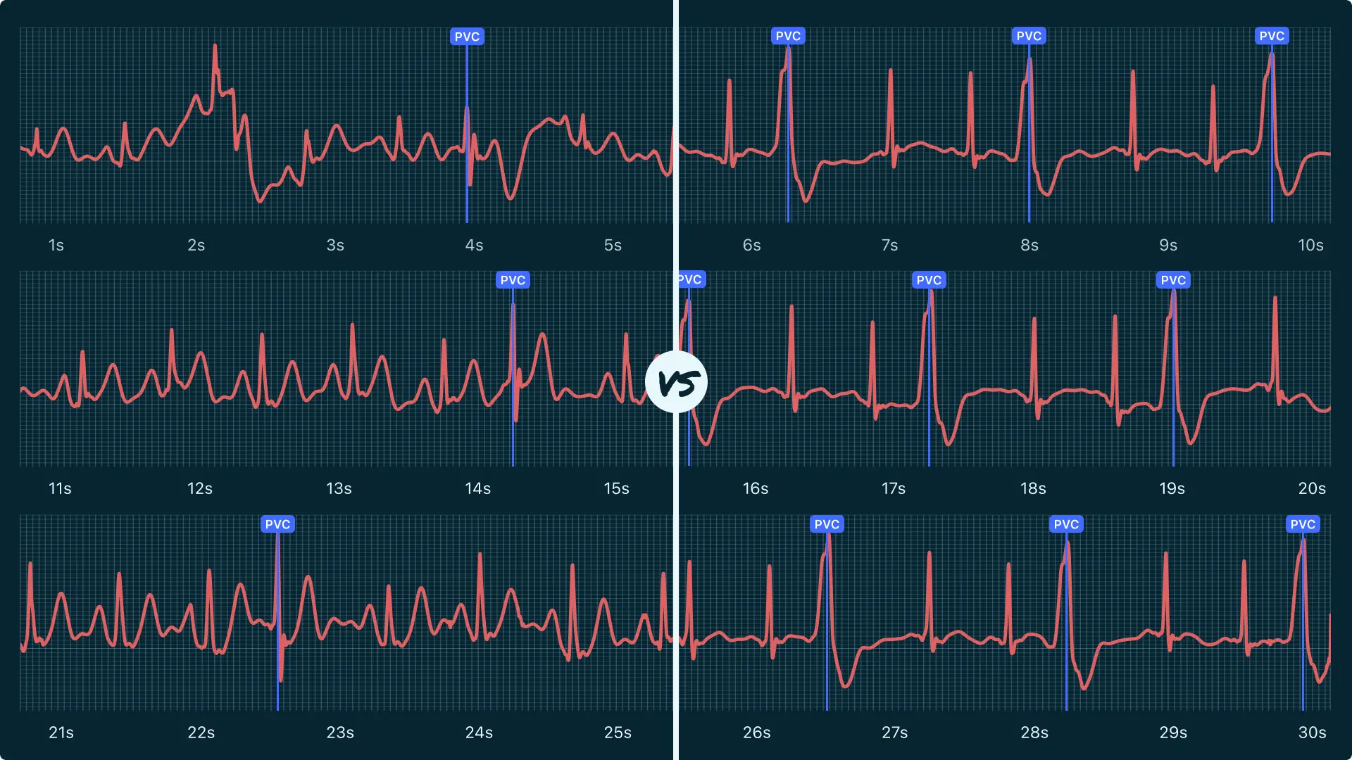 Premature Ventricular Contraction (Multiple) Vs. Ventricular Trigeminy on Your Watch ECG | Qaly
